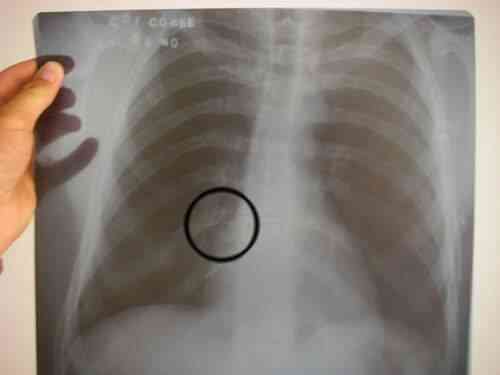 Wie heilt eine gebrochene Rippe?