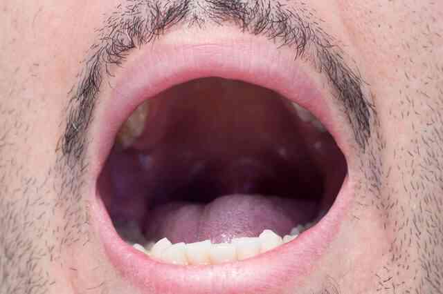 Tonsillensteine entfernen