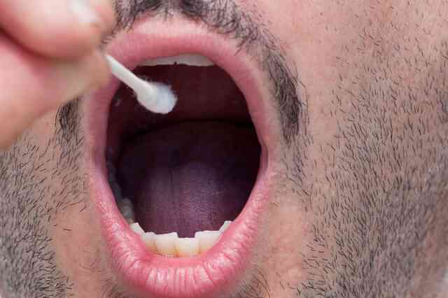 Tonsillensteine entfernen